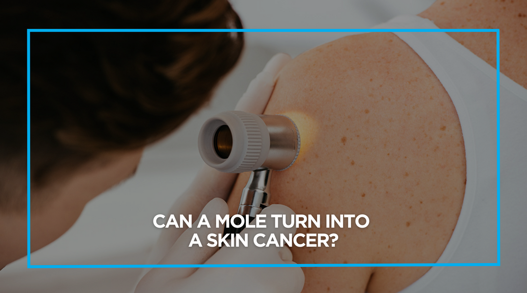 Can a mole turn into a skin cancer? – SParms